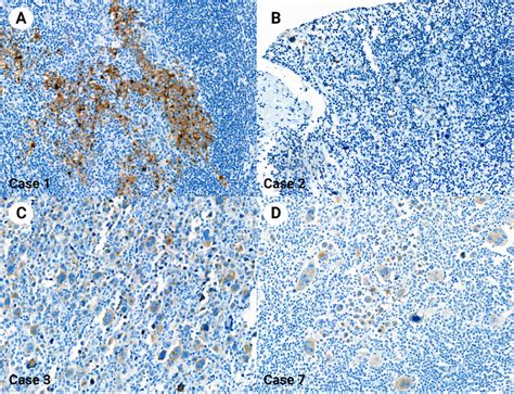 Classic Hodgkin Lymphoma Stained With Synaptophysin Clone Sp11 The Download Scientific Diagram
