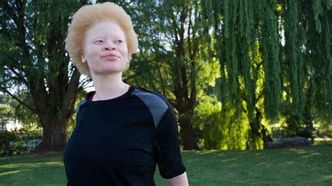How To Prevent Albinism Understandingbench16