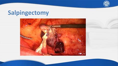 Ppt Ectopic Pregnancy Powerpoint Presentation Free Download Id2176500