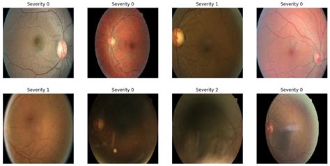 Dr Nasnet Automated System To Detect And Classify Diabetic Retinopathy Severity Using Improved