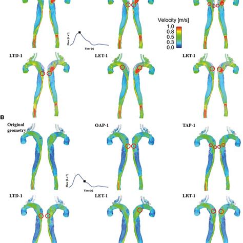 Velocity Streamlines For Patient 1 And The Corresponding Modified