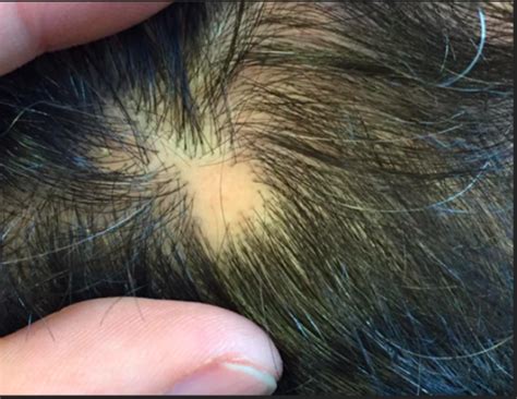 Pseudopelade Of Brocq — Donovan Hair Clinic
