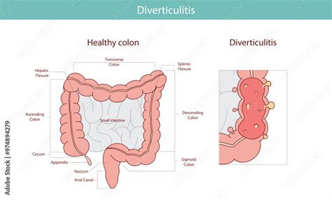Intestinal Diverticulitis Anatomical Illustration Of The Rectum Appendix Small Intestine In