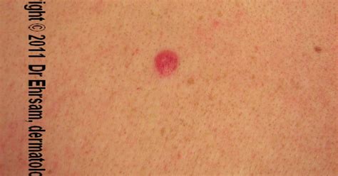 Dermoscopy Red Nodule