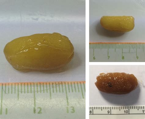 Ghost Tablets Mimicking Intestinal Parasite The Brazilian Journal Of Infectious Diseases