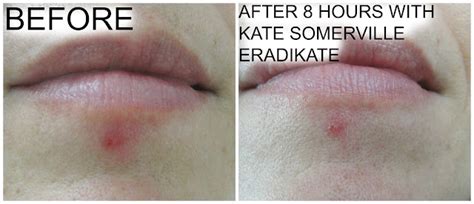 HOW TO GET RID OF A PIMPLE OVERNIGHT