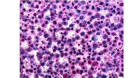 Pathology Art Print Burkitt Lymphoma Hematology Etsy