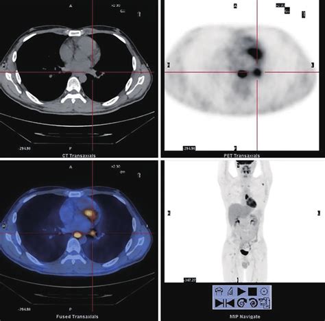 Pet Ct Revealed That The Standard Uptake Value Suv Was Elevated At