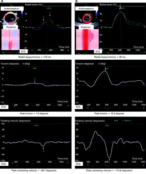 Determinants Of Left Ventricular Untwisting Behaviour In Patients With Dilated Cardiomyopathy