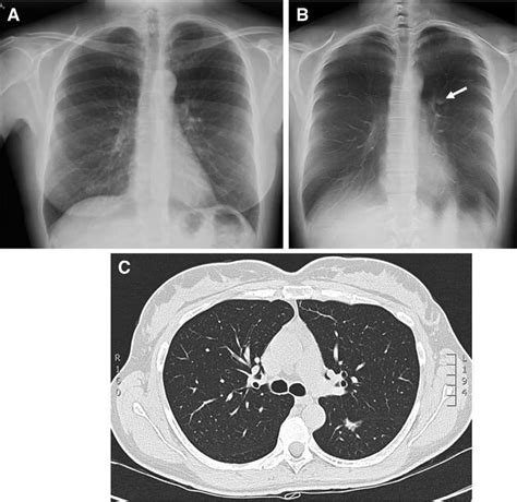 Digital Chest Tomosynthesis Image Showing A Solid Pulmonary Nodule In A Download Scientific