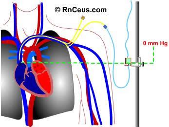 SUPAHNARS CVP Central Venous Pressure Monitoring