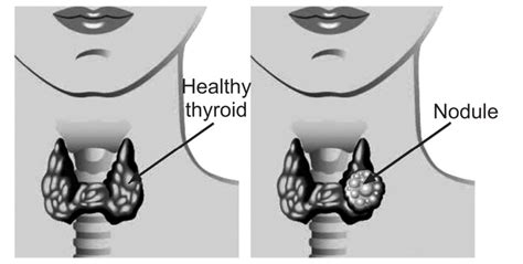 Thyroid Cancer Symptoms Treatment Types Thyroid Nodules Pharmacy Medicine Drugs
