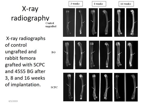 New Bone Formation In Orthopedic Defect Treated With Scpc Vs