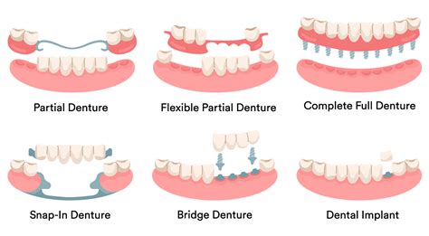 Dentures In Covington Full Partial Options