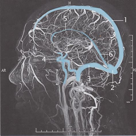 Cavernous Sinus Thrombosis Mrv