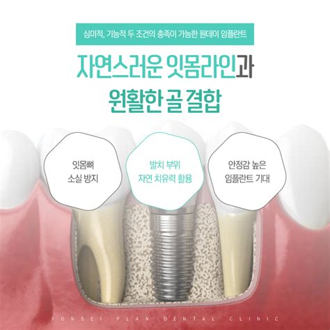 연세플랜치과 바쁜 일상생활로 잦은 치과 내원과 긴 회복기간이 부담되는 분들께 적합하다고 할 수