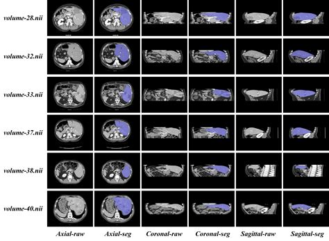 Advancing Liver Segmentation With Deep Learning Leadsnite