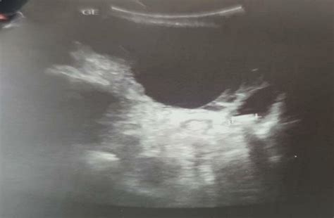 Ultrasound Image Showing Bladder Diverticulum With Calculus Within It Download Scientific Diagram