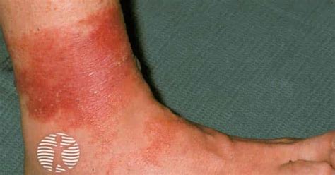 Dermnet® Phytophotodermatitis Image