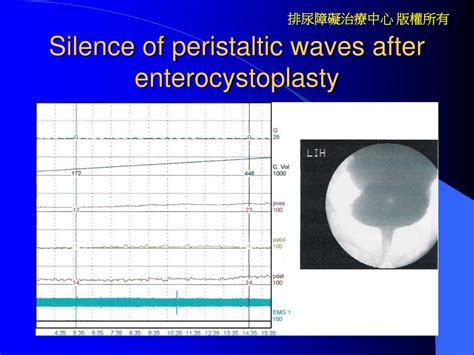 Ppt Enterocystoplasty Powerpoint Presentation Free Download Id5542674