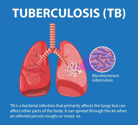 Tuberculosis Outbreak 2025 Symptoms Vaccines And Trends