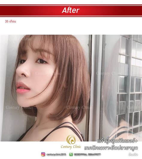 อัพเดท แก้จมูก 35 เดือน Century Health Clinic