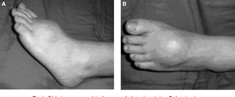 Figure 1 From Dislocation And Relocation Of The Tarsometatarsal Joint As An Approach For