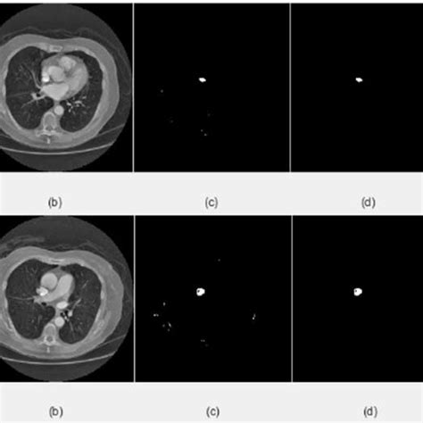 A Dicom Lidc Dataset Ct Lung Image Download Scientific Diagram