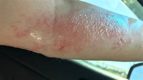 Poison Sumac Skin Reaction At Peggy Rios Blog