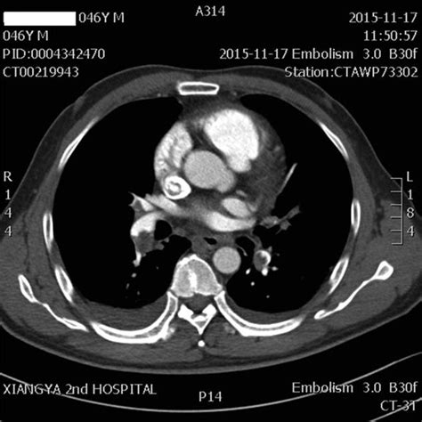 A Pulmonary Cta Shows Improvement Of The Pulmonary Embolism B Download Scientific Diagram