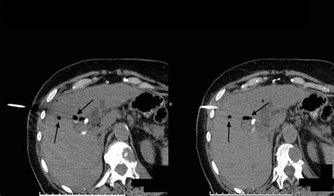 Localised Pneumoperitoneum Following Liver Mass Biopsy In The Setting