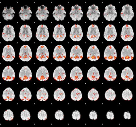Functional Connectivity Analysis Of Resting State Fmri Data Using Fsl