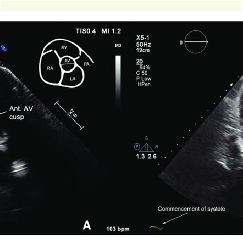 Transition Steps From Ecmo To Protek Duo® Ecmo Extracorporeal Membrane