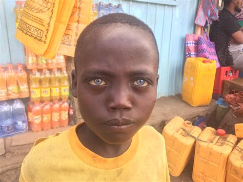 Ocular Albinism Pictures Ocular Albinism