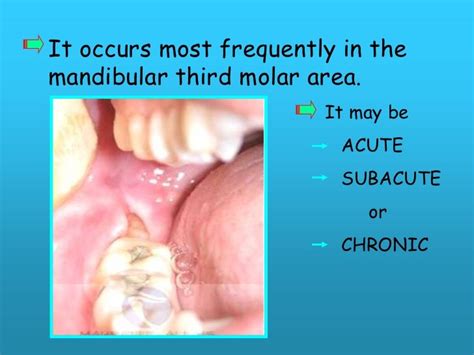 Pericoronitis