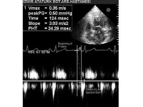 Interatrial Conduction Time Is Calculated As The Time Interval Between