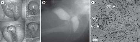 Figure 1 From Preserved Fertility In A Patient With A 46xy Disorder Of
