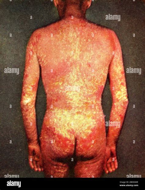 Erythroderma Also Known As Exfoliative Dermatitis Dermatitis
