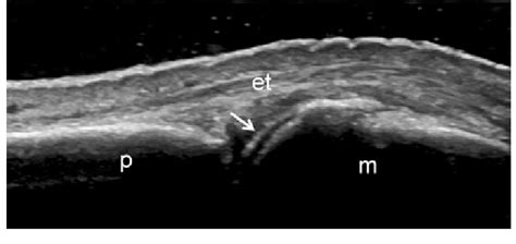 Second Metacarpophalangeal Joint Of The Left Hand Dorsal Longitudinal