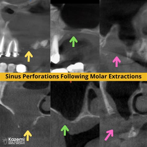 Tooth Extraction In Sinus Cavity At Vivian Nelson Blog