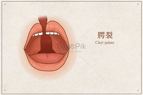 Schematic Diagram Of Cleft Palate Medical Illustration Illustration