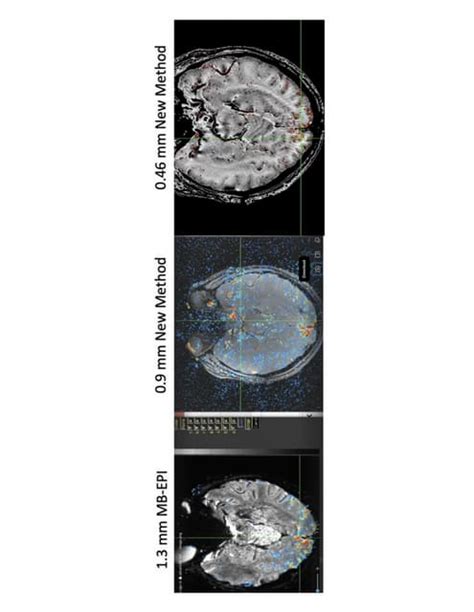 Laminar Fmri At 3t Using Dual Echo Rosette With A Te 15 Us Pdf