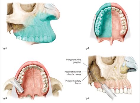 Local Anesthesia Intraoral Injections Neupsy Key