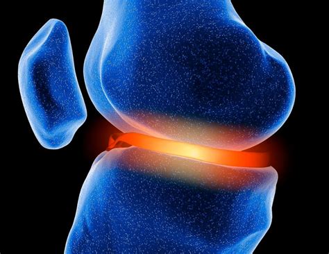 Workers Comp Meniscus Tear Settlement