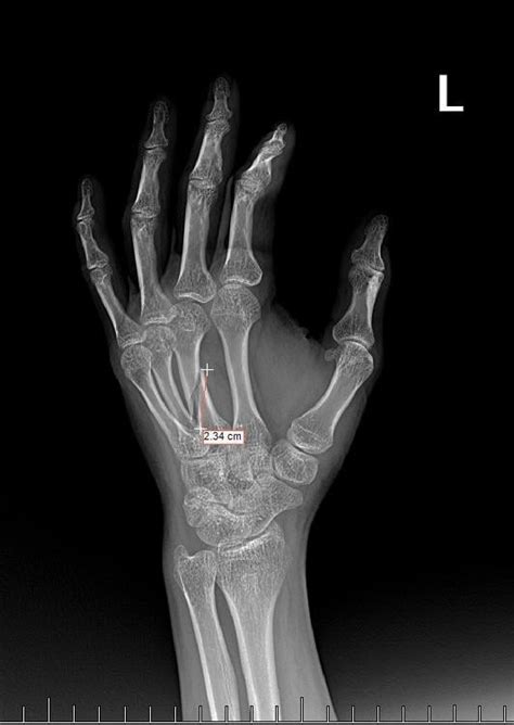 Orif Of 3rd Metacarpal Oblique Fracture Dt Falling Down Stairs Rxrays