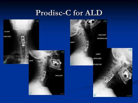 Ppt Disc Replacement Vs Fusion Surgery Powerpoint Presentation Free