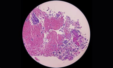 In Focus Sarcoma Medical Independent