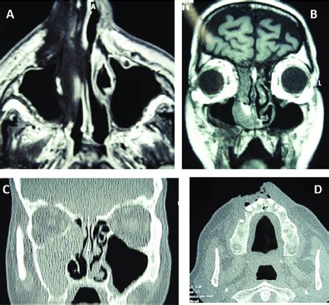 A B Mri Scan Shows Necrosis Of The Entire Right Nasalparanasal