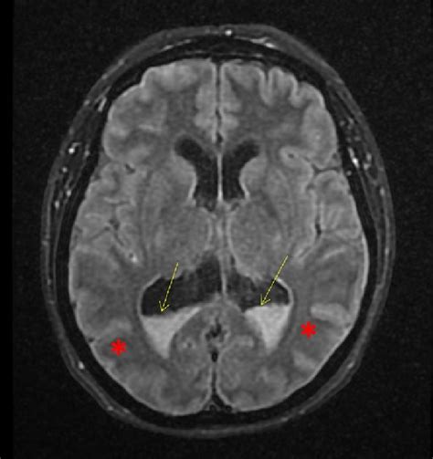 Brain Mri Massive Intraventricular Purulent Collection Deposited In