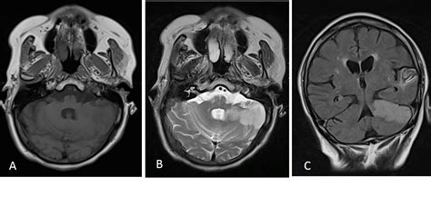Cerebellar Vermis Infarct Mri
